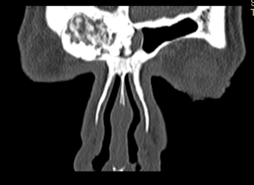 Tumori benigne de sinusuri - Dr. Bogdan Mocanu