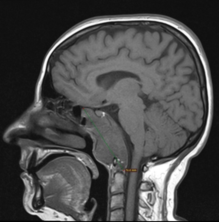 ABORDUL CHIRURGICAL TRANSNAZAL AL TUMORILOR PROFUNDE DE BAZĂ DE CRANIU ...