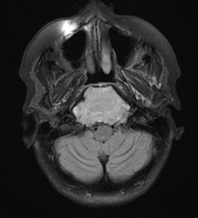 ABORDUL CHIRURGICAL TRANSNAZAL AL TUMORILOR PROFUNDE DE BAZĂ DE CRANIU ...