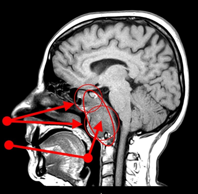 ABORDUL CHIRURGICAL TRANSNAZAL AL TUMORILOR PROFUNDE DE BAZĂ DE CRANIU ...