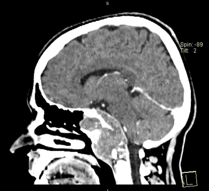 ABORDUL CHIRURGICAL TRANSNAZAL AL TUMORILOR PROFUNDE DE BAZĂ DE CRANIU ...