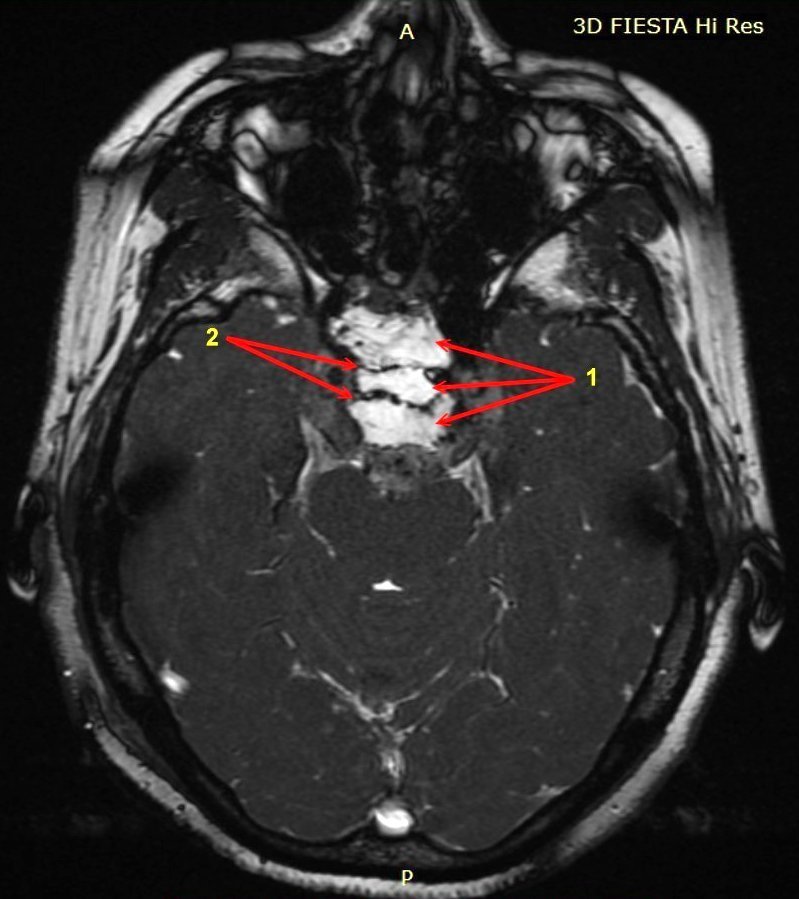 ÎNCHIDEREA UNUI DEFECT DE MARI DIMENSIUNI ÎN BAZA DE CRANIU DUPĂ ...