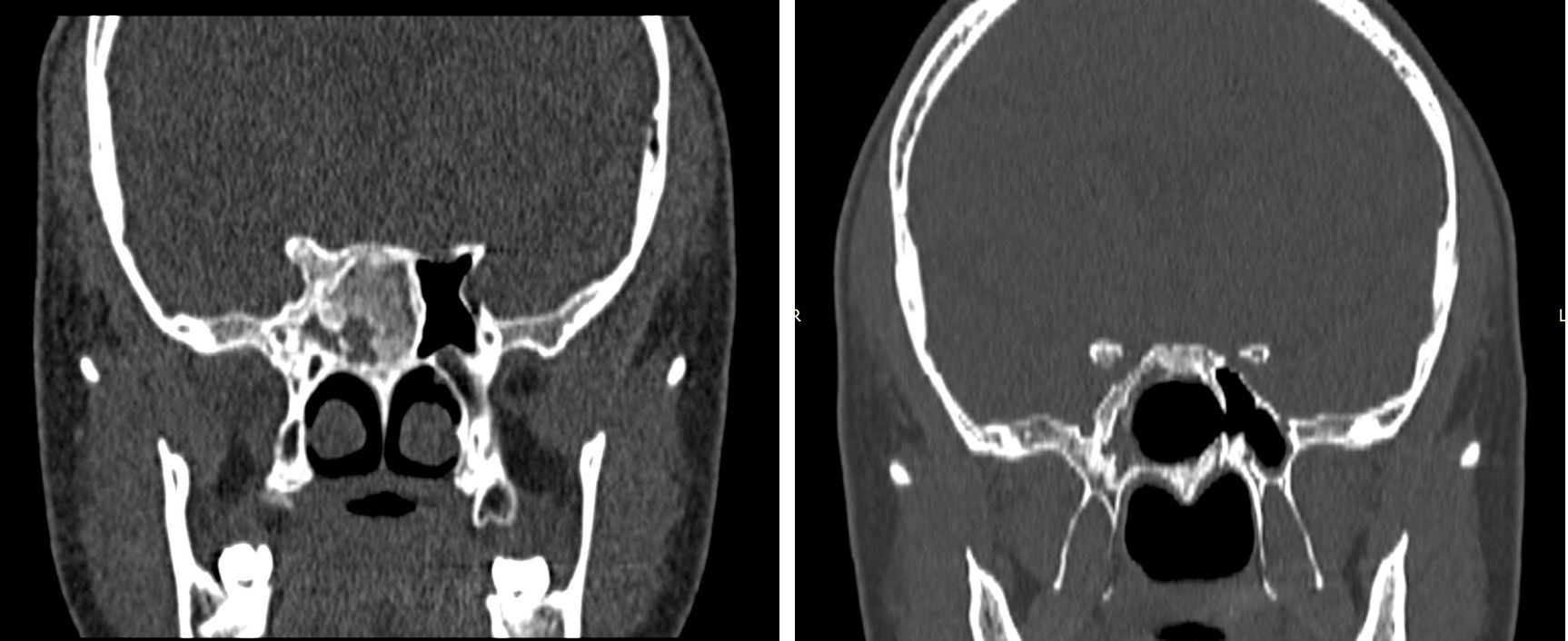 DISPLAZIE FIBROASA DE SFENOID DREPT – CAZ CLINIC - Dr. Bogdan Mocanu
