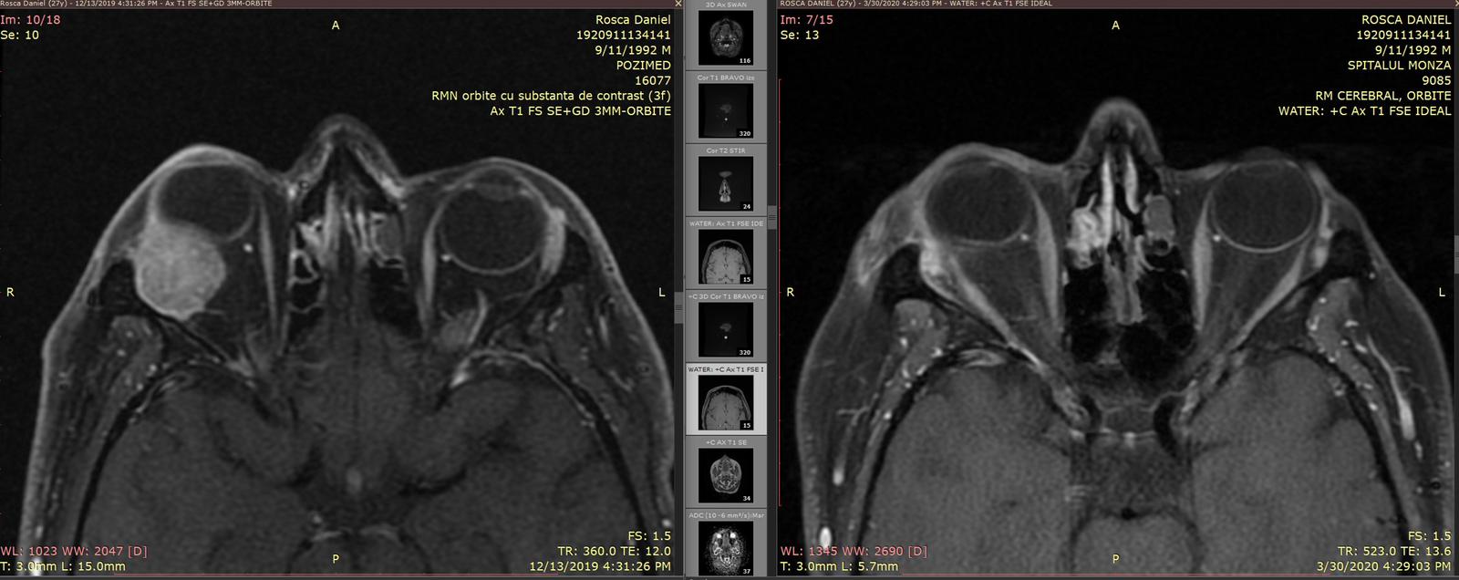 ABLAȚIA EXCLUSIV ENDOSCOPIC MINIM INVAZIV TRANSCUTANAT A UNEI TUMORI ...